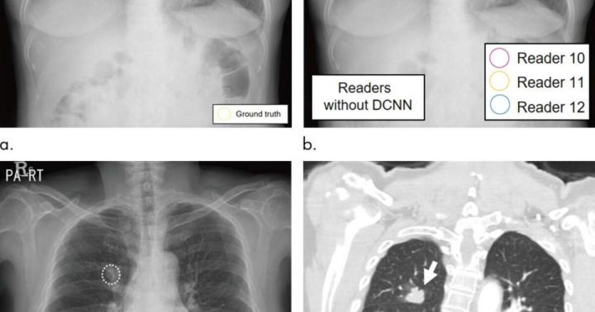 Deep learning helps radiologists detect malignant lung nodules | Health ...